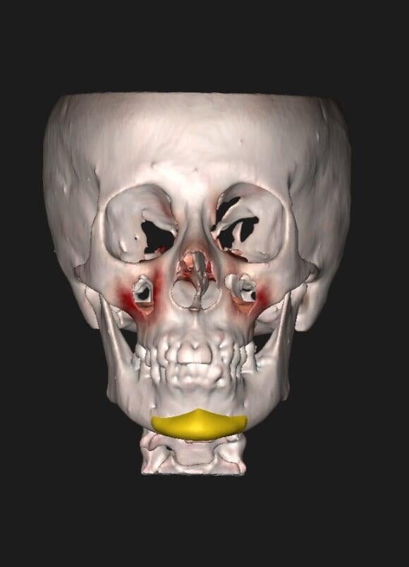 Facial Plastic Surgery | LUCID Implants